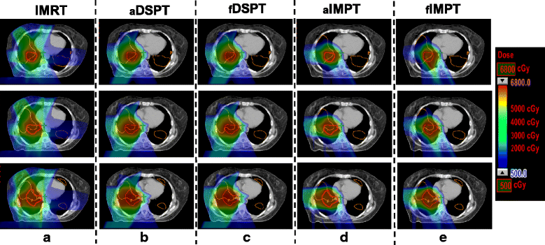 Dosimetric feasibility of 4DCT-ventilation imaging guided proton ...
