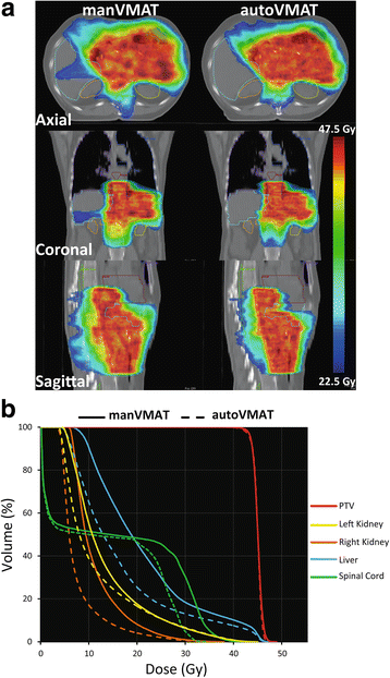 Automated VMAT planning for postoperative adjuvant treatment of ...