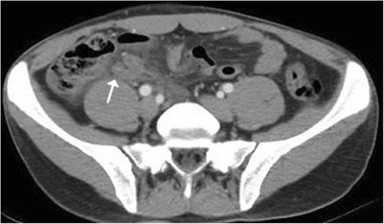 Stump appendicitis: a retrospective review of 3130 consecutive ...