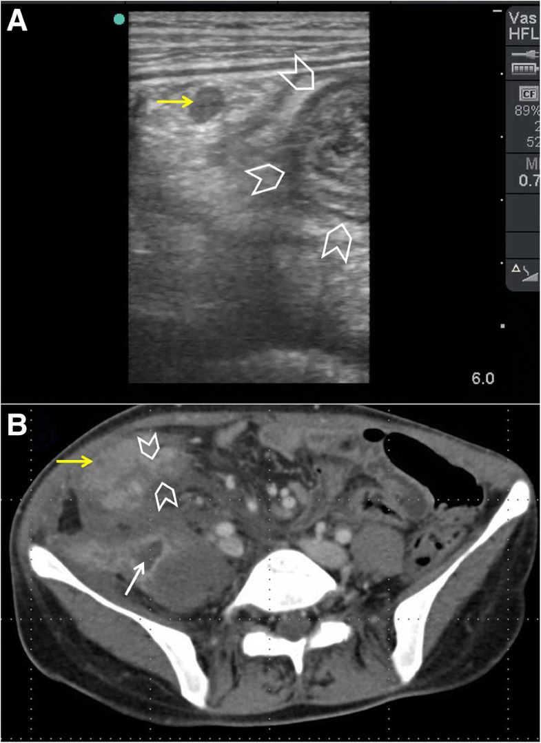 Diagnostic point-of-care ultrasound (POCUS) for gastrointestinal ...