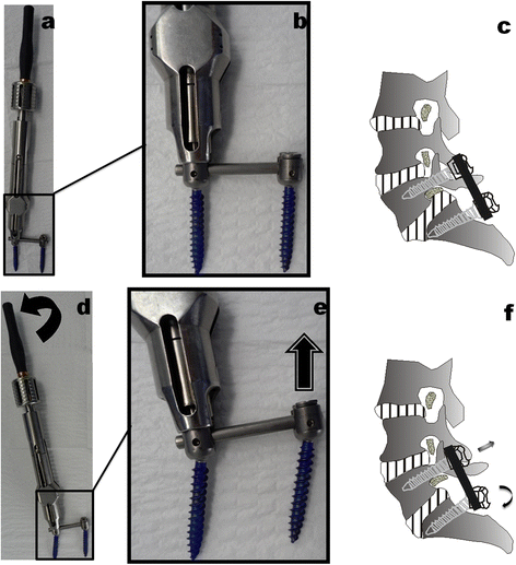 Lever reduction using polyaxial screw and rod fixation system for the ...