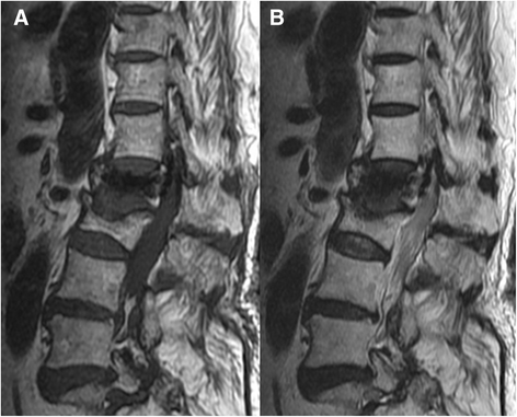 Posterior transpedicular approach with circumferential debridement and ...