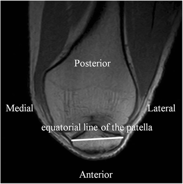 Distal femoral condyle is more internally rotated to the patellar ...
