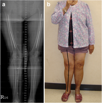 Total knee arthroplasty in patients with Ranawat type-II valgus ...