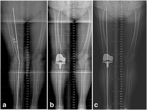 Total knee arthroplasty in patients with Ranawat type-II valgus ...