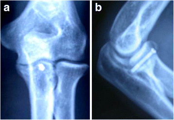 Arthroscopic reduction and fixation of coronoid fractures with an ...