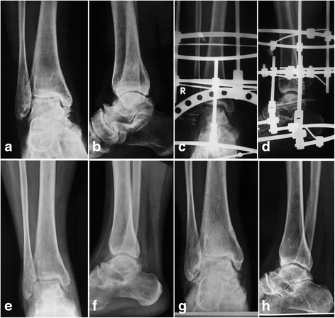 Functional analysis of distraction arthroplasty in the treatment of ...