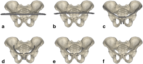 Biomechanical characteristics of fixation methods for floating pubic ...