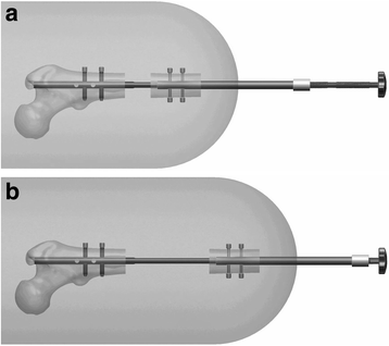 Novel intramedullary device for lengthening transfemoral residual limbs ...