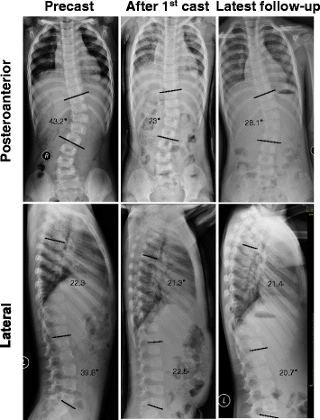 The therapeutic characteristics of serial casting on congenital ...