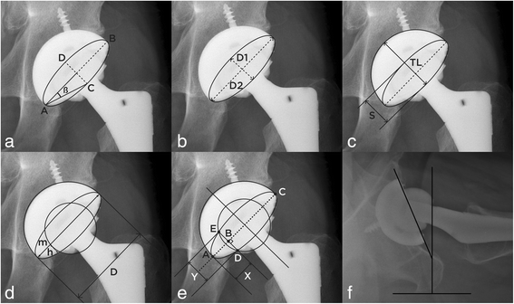 The best method for evaluating anteversion of the acetabular component ...