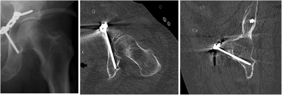 A guideline for placement of an infra-acetabular screw based on ...
