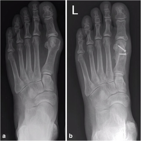 The influence of the number of screws and additional surgical ...