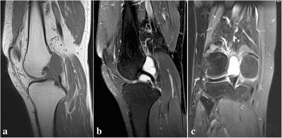 Clinical manifestation and arthroscopic treatment of symptomatic ...