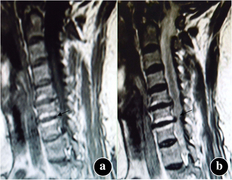 Modic changes in the cervical endplate of patients suffering from ...
