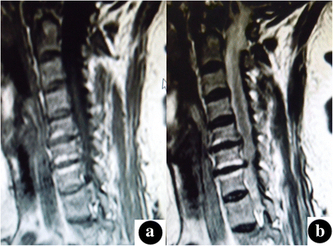 Modic changes in the cervical endplate of patients suffering from ...