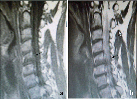 Modic changes in the cervical endplate of patients suffering from ...