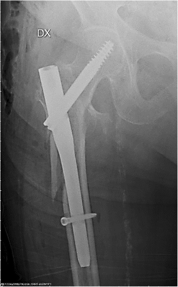 Greater rate of cephalic screw mobilisation following proximal femoral ...