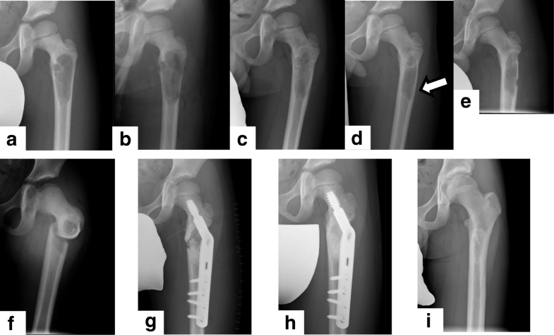 Treatment of simple bone cysts using endoscopic curettage: a case ...