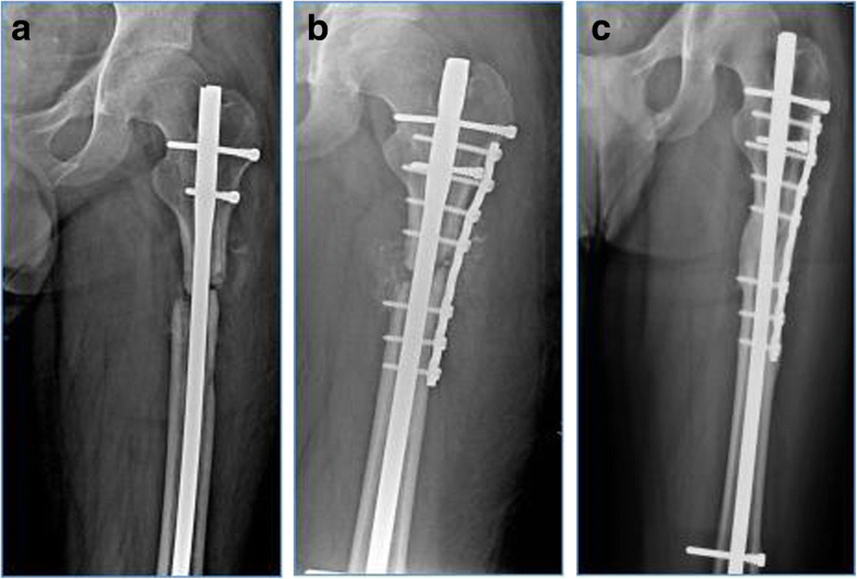 Factors associated with development of re-nonunion after primary ...