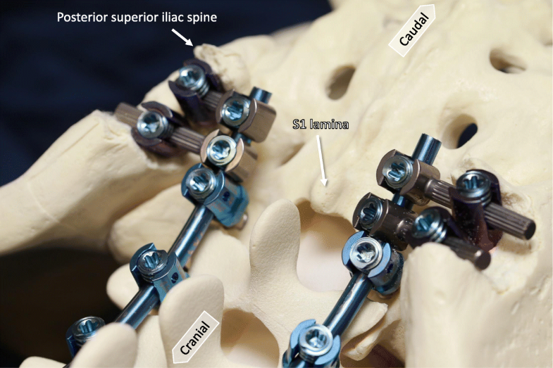 Bilateral dual iliac screws in spinal deformity correction surgery ...
