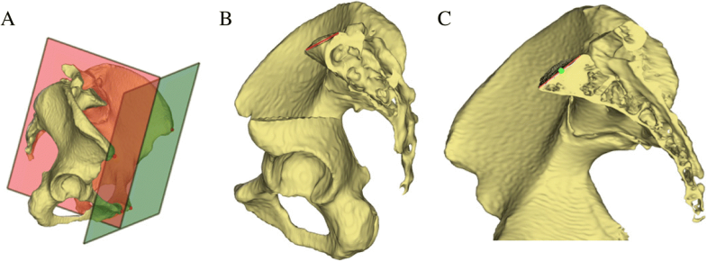 Pelvic incidence measurement using a computed tomography data-based ...