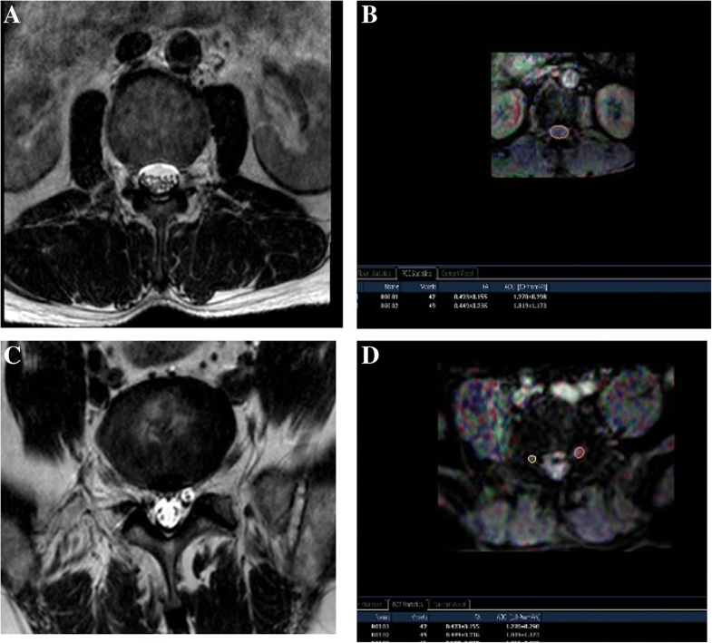 Relationship between the benefits of paraspinal mapping and diffusion ...