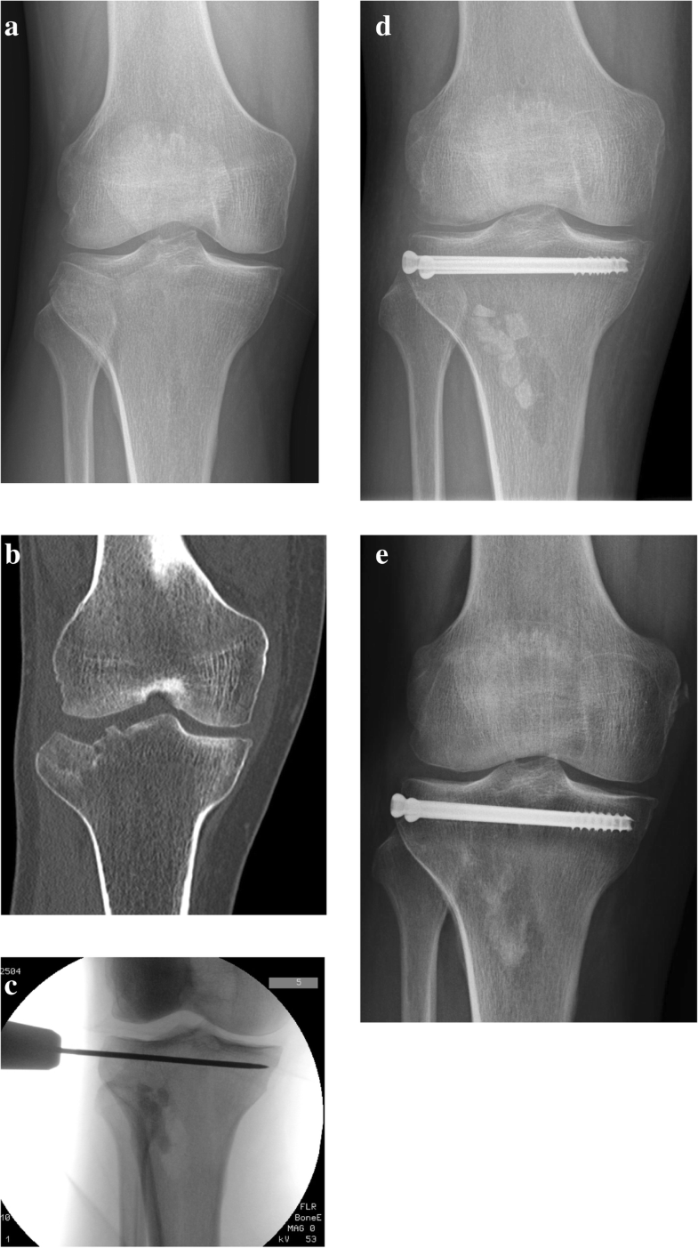 Arthroscopically assisted reduction and internal fixation (ARIF) versus ...