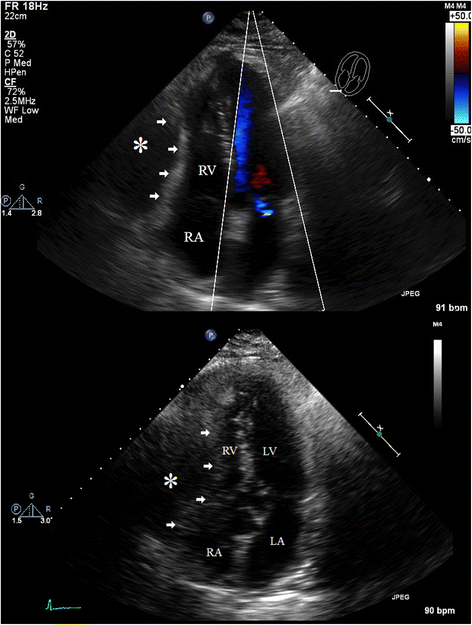 Extra-pericardial tamponade following Wolf Mini-Maze procedure: a case ...