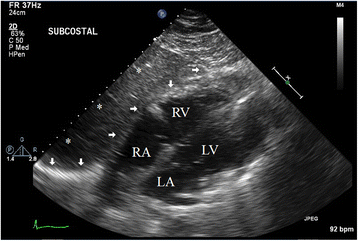 Extra-pericardial tamponade following Wolf Mini-Maze procedure: a case ...