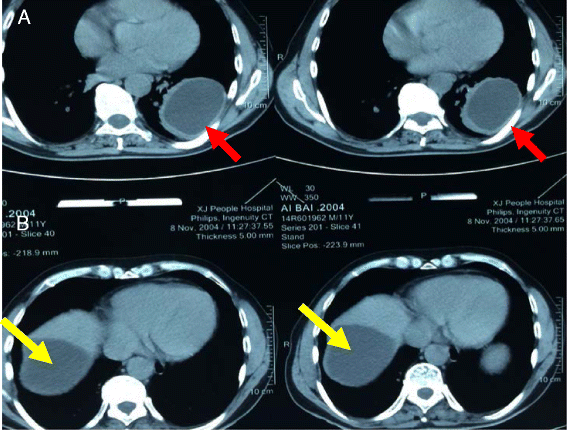 Therapeutic evaluation of video-assisted thoracoscopic surgery versus ...