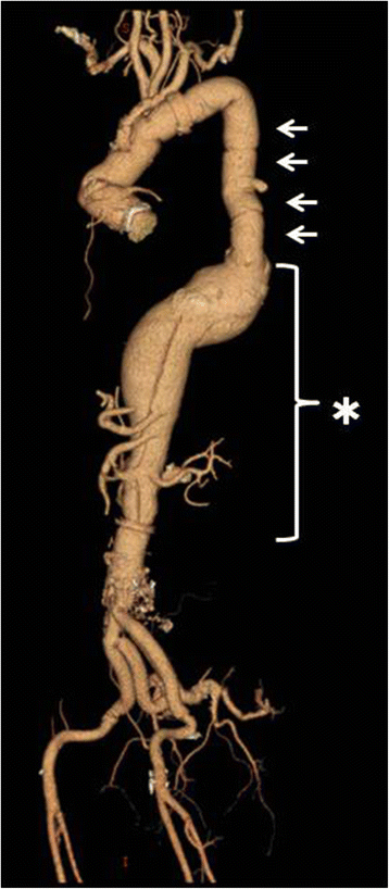 Transapical aortic perfusion using a deep hypothermic procedure to ...