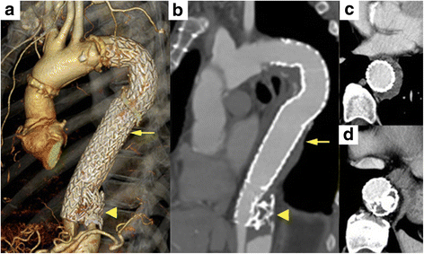 Modified ‘candy-plug’ technique for chronic type B aortic dissection ...