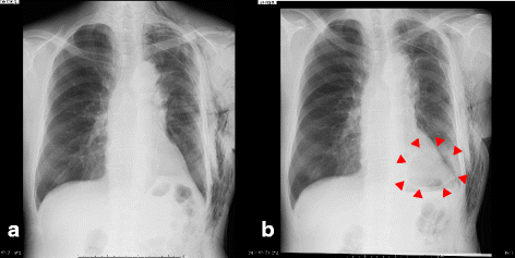 Visceral subpleural hematoma of the left diaphragmatic surface ...