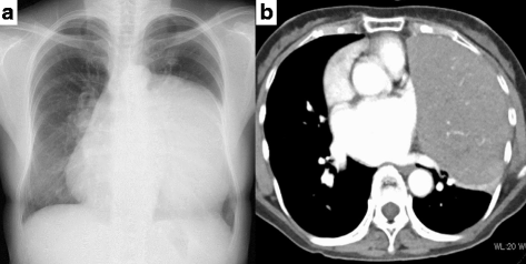 Giant thymoma successfully resected via median sternotomy and anterolateral thoracotomy: a case ...