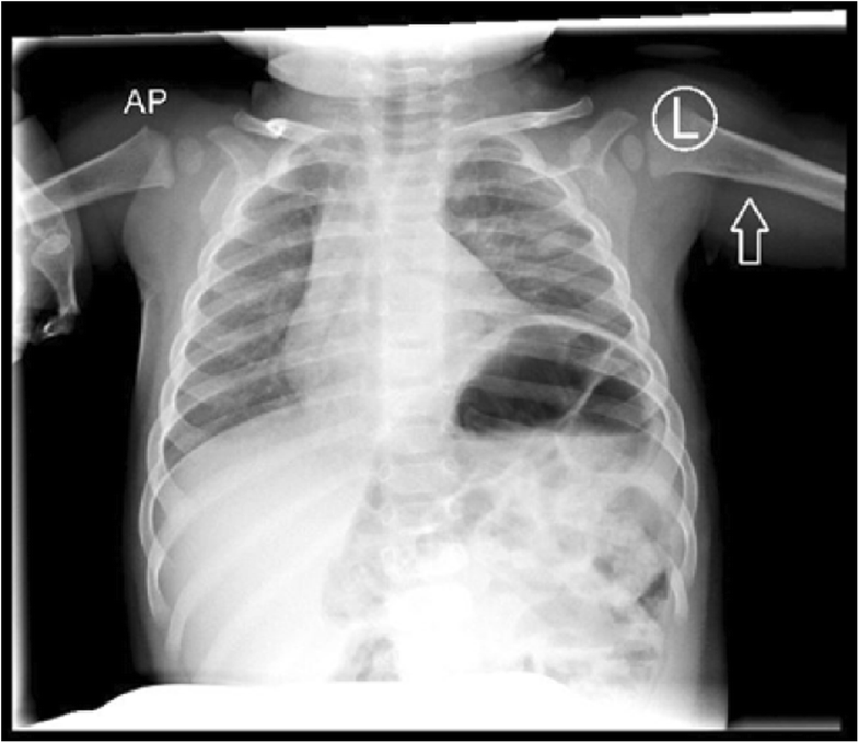 Extrapulmonary sequestration with a left internal thoracic arterial ...