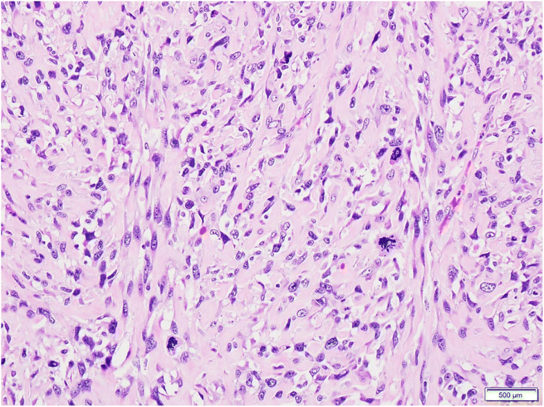 R0 resection and reconstruction for a large, rapidly progressive chest ...