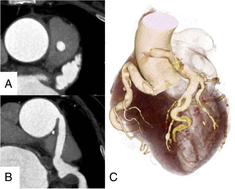 Reconstruction of anomalous left coronary artery from pulmonary artery ...