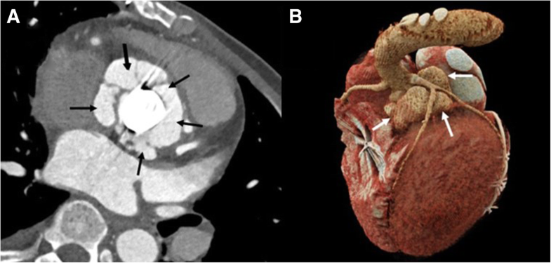 Value of cardiac computed tomography angiography in pre-operative ...