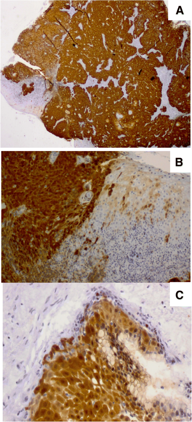 Human papillomavirus (HPV) and Epstein-Barr virus (EBV) in keratinizing ...