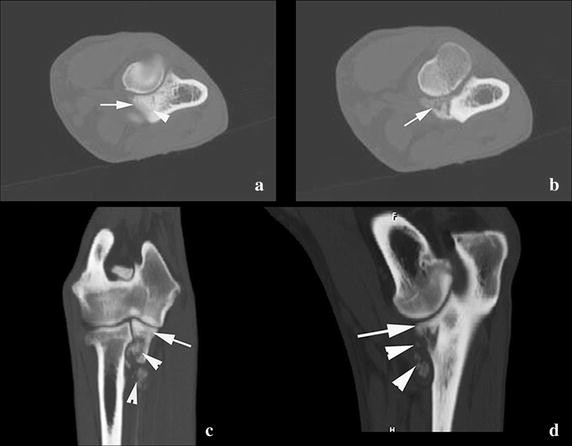 A chondroblastic osteosarcoma of the coronoid process mimicking a ...