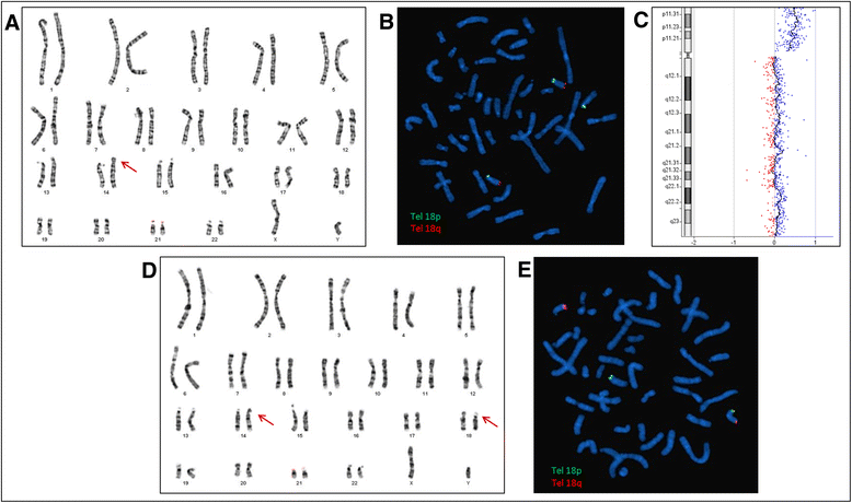 Azoospermia and trisomy 18p syndrome: a fortuitous association? A ...