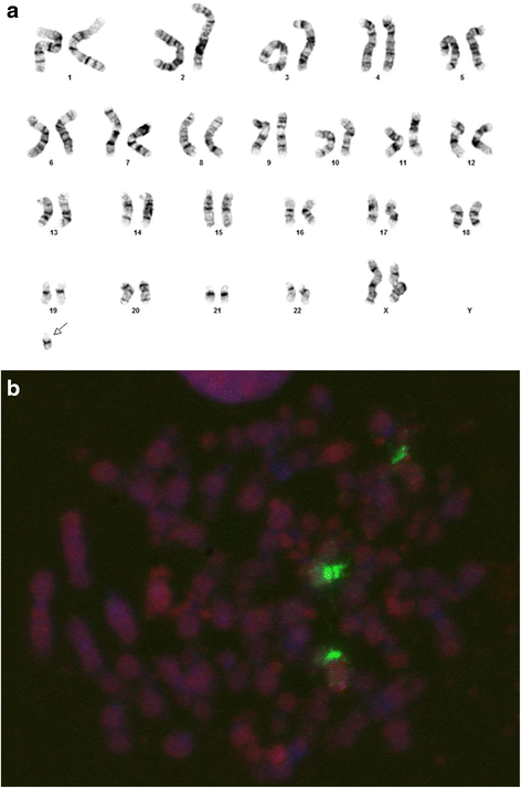 A marker chromosome in post-transplant bone marrow | Molecular ...