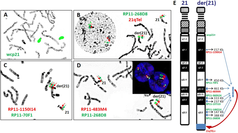 Stable transmission of an unbalanced chromosome 21 derived from ...