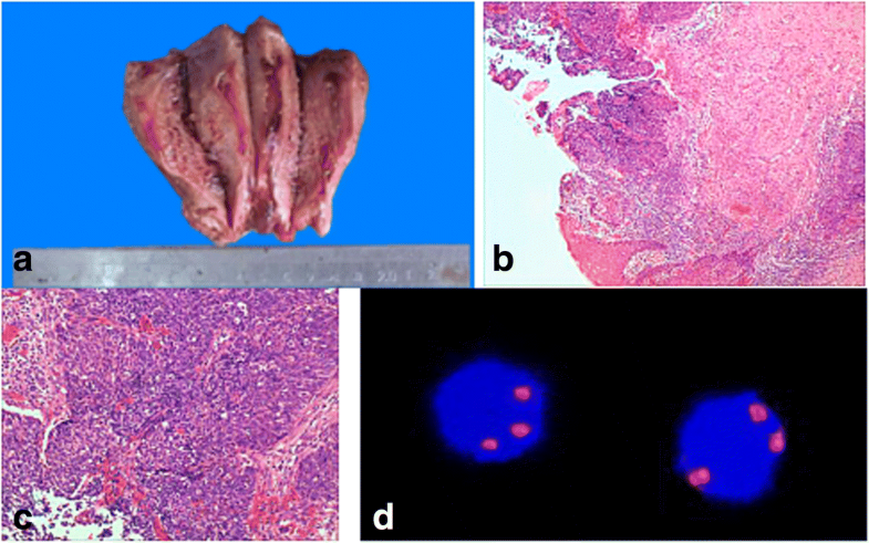 Superficially invasive cervical squamous cell carcinoma metastatic to ...