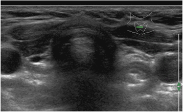 Congenital hypothyroidism due to ectopic sublingual thyroid gland in ...