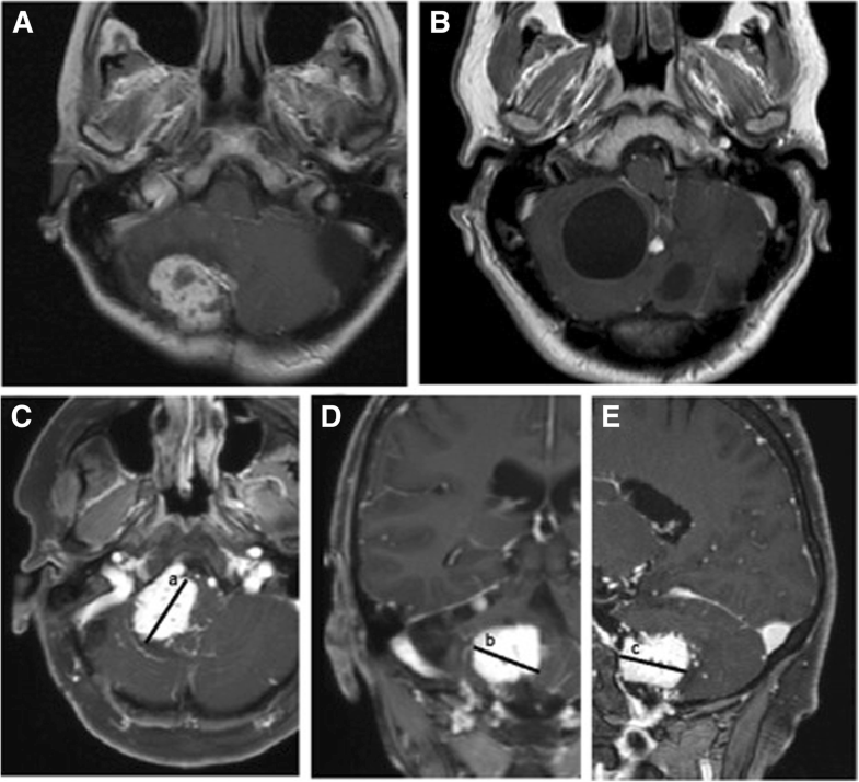 Polyglobulia in patients with hemangioblastomas is related to tumor ...