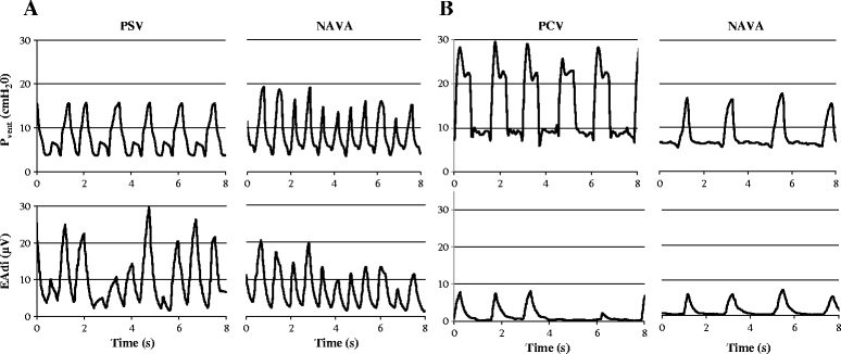 Neurally adjusted ventilatory assist (NAVA) allows patient-ventilator ...