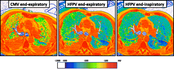 High frequency percussive ventilation increases alveolar recruitment in ...