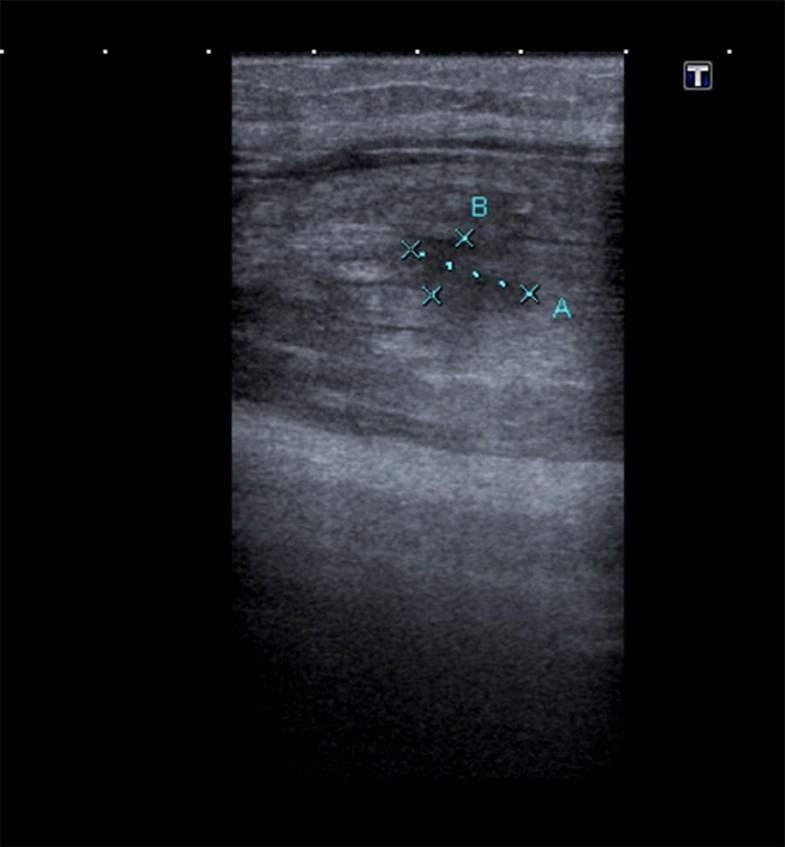 A rare ultrasound case report: intramuscular tear of the sartorius ...